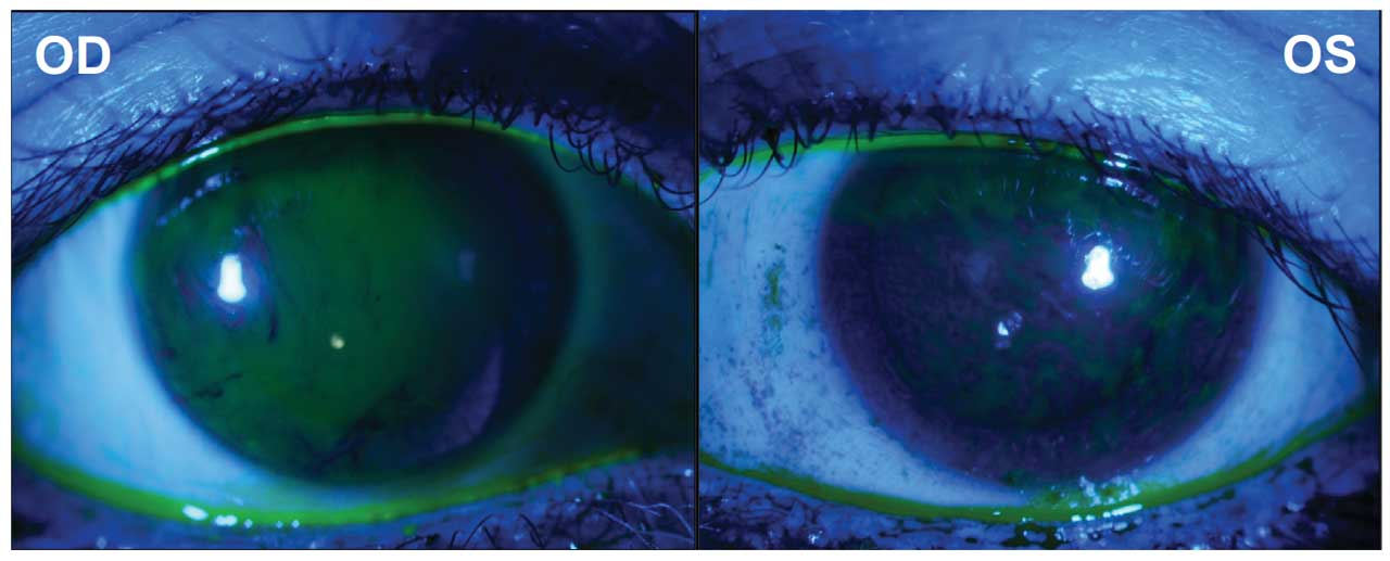 Dry Eye Diagnostics in Real-Time Practice | Ophthalmology Management