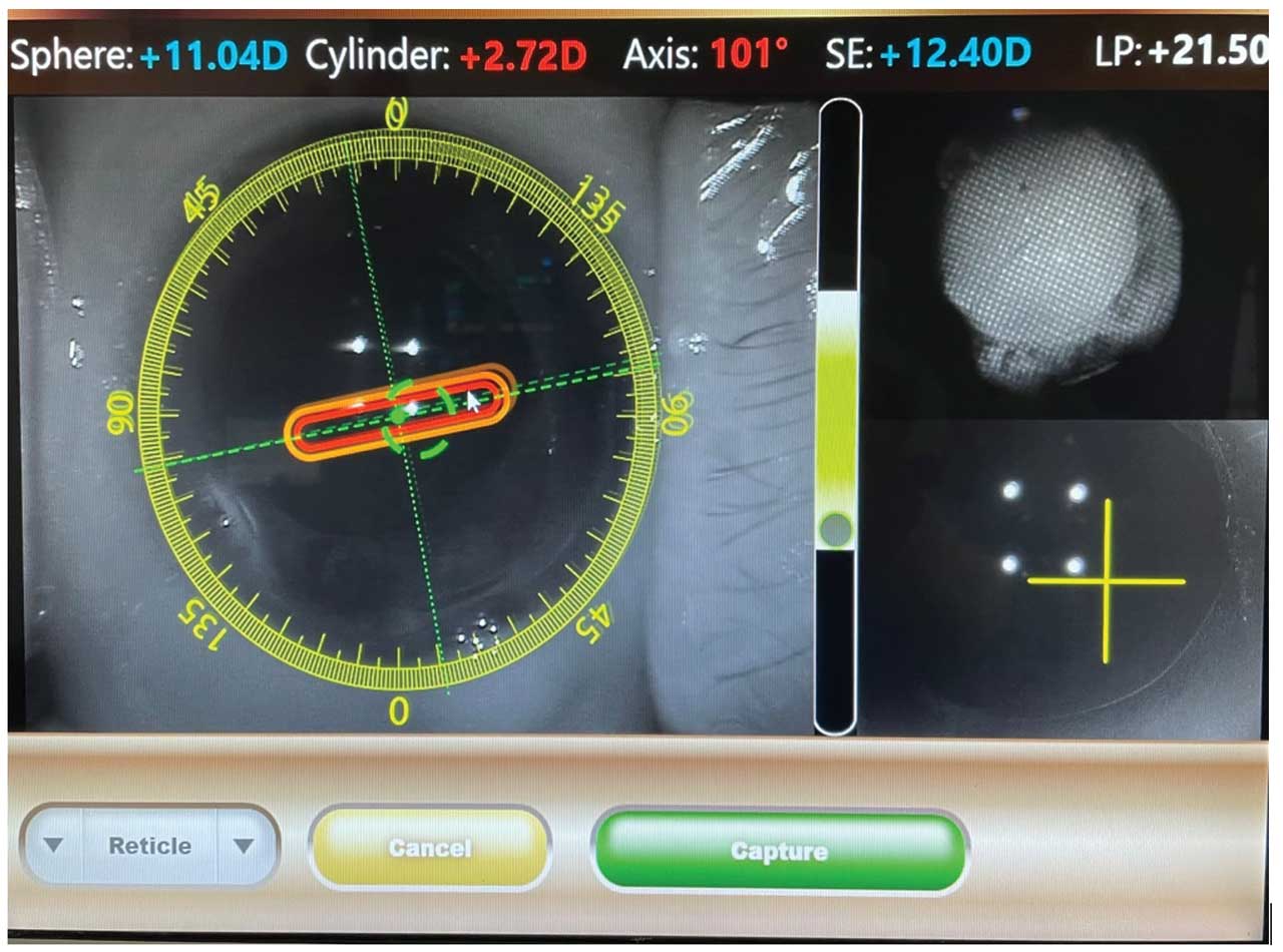 YOUR GUIDE TO IMPROVING REFRACTIVE OUTCOMES | Ophthalmology Management